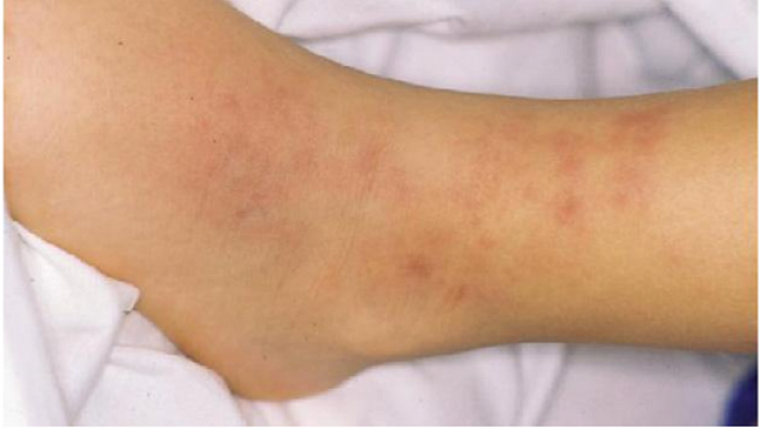 ANCA associated Vasculitis